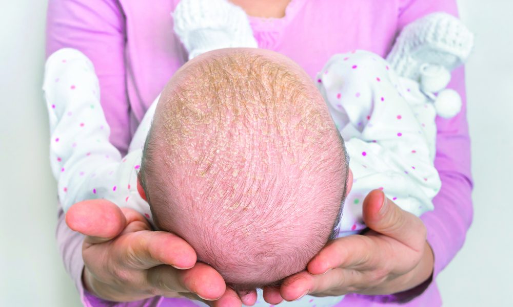 4 common skin problems in newborns - Royal Examiner