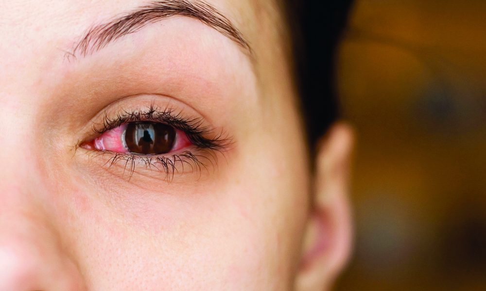Conjunctivitis: causes, symptoms, diagnosis and treatment - Royal Examiner
