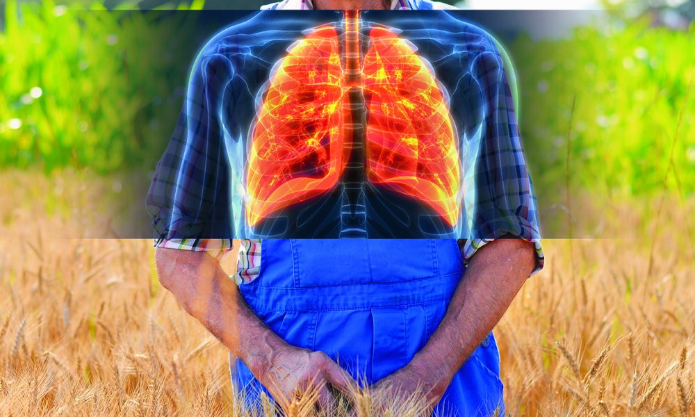 What’s farmer’s lung? - Royal Examiner